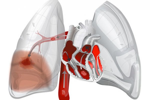 Šta je PLUĆNA EMBOLIJA? | Novi.ba
