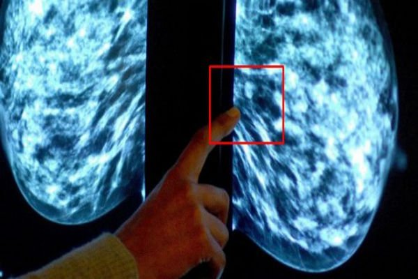 OTKRILI SU JOJ RAK DOJKE, A OVO JE JEDINI SIMPTOM KOJI JE IMALA: Žene ...