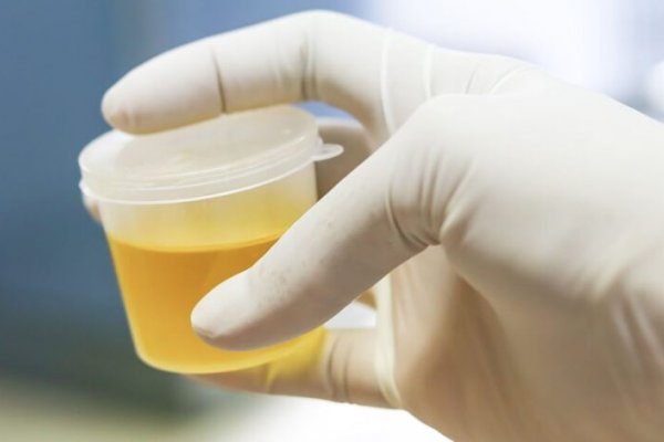 BOJA URINA otkriva mnoge ozbiljne bolesti, pa čak i RAK: 7 RAZLOGA zbog ...