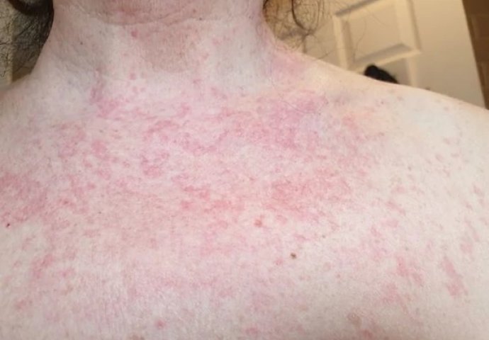 KOŽA VAS SVRBI, ruke i noge TRNU? Stalno ste ŽEDNI? Ove SIMPTOME ne ...