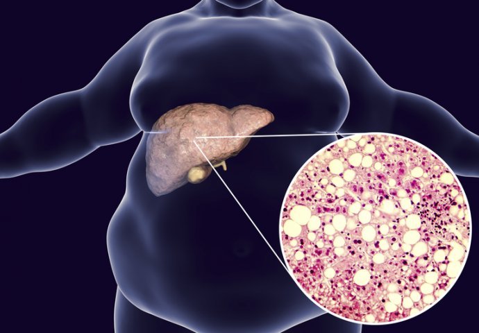 8 SIMPTOMA RAKA JETRE: Ovaj karcinom je najteže ustanoviti, evo kako ...