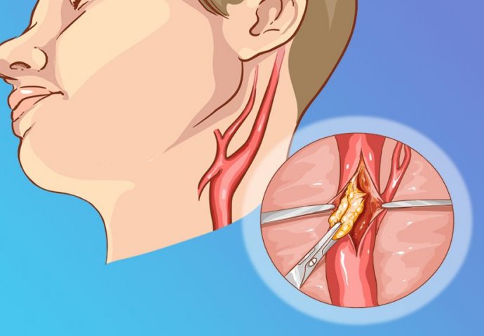 VRTI VAM SE U GLAVI, A MOŽDA IMATE MINI MOŽDANI UDAR: Kako prepoznati sužene karotide | novi.ba